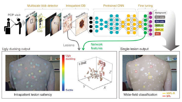 deep learning based melanoma screening tool uses ugly duckling method ...