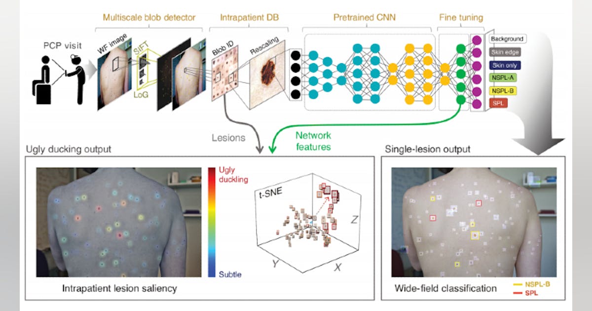 Deep Learning Based Melanoma Screening Tool Uses Ugly Duckling Method Vision Systems Design